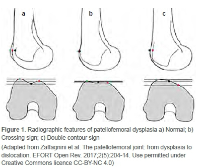 Patellar Glide Grading