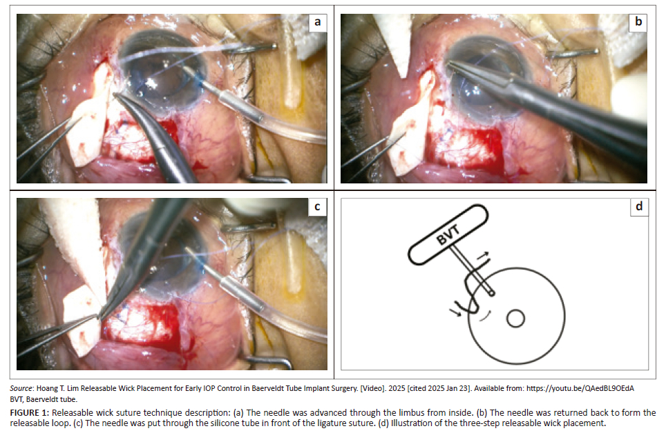 A novel releasable wick suture for early intraocular pressure control ...