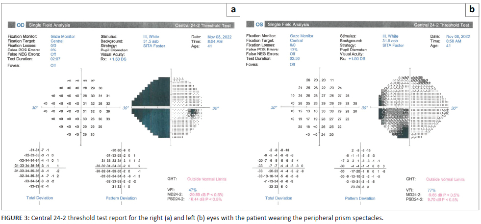 A clinical case report of left homonymous hemianopia