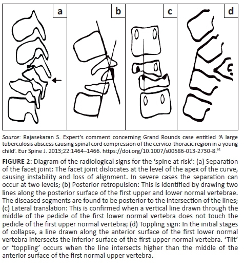 Could an increase in vigilance for spinal tuberculosis at primary ...