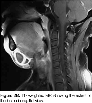 Plunging Ranula Ultrasound