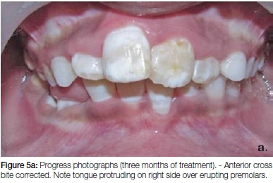 Pathogenesis Of Dentigerous Cyst