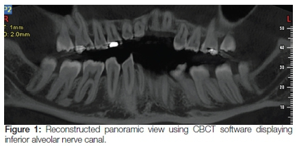 External Oblique Ridge Cbct