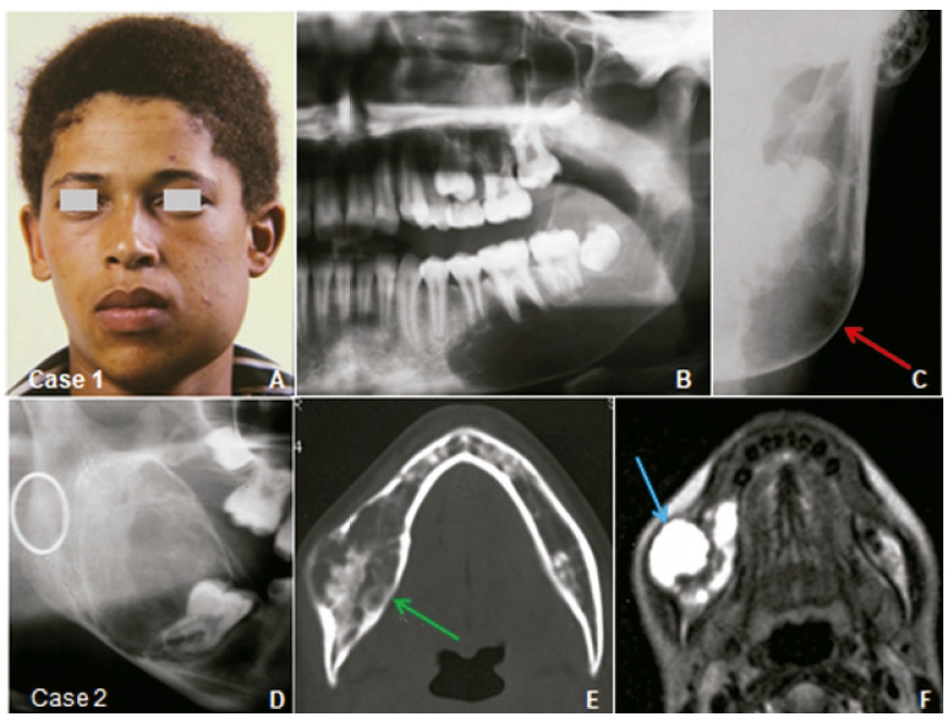 Aneurysmal Bone Cyst Jaw