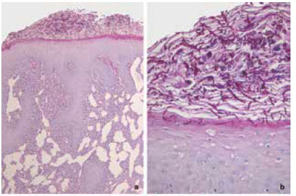 Oral Candidiasis Histology