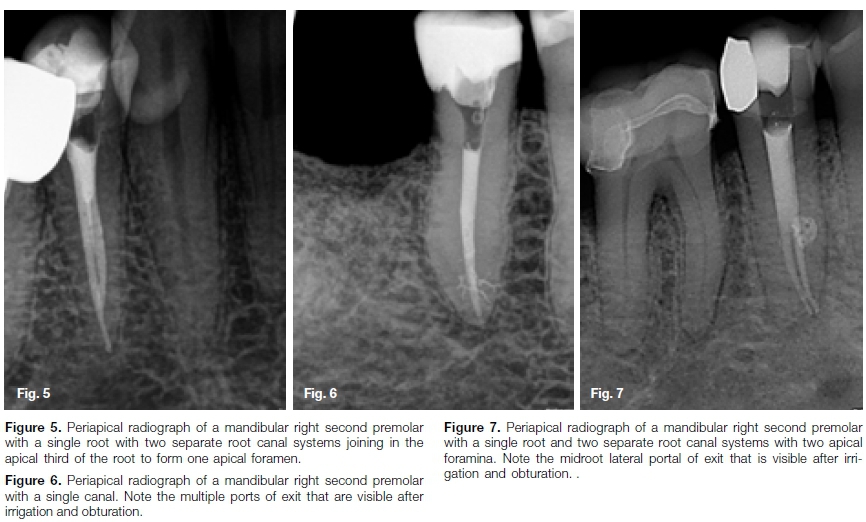 Mandibular first and second premolars with challenging root canal ...