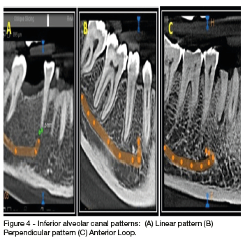 Mental Ridge Cbct