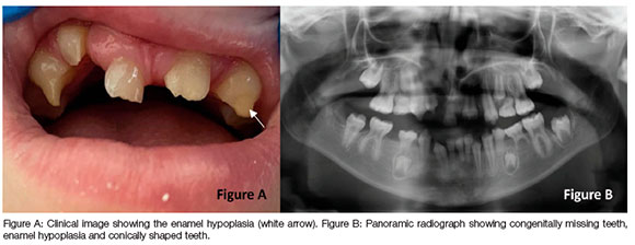 Ectodermal dysplasia