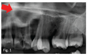 Dens Invaginatus