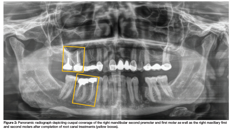 Dentine thicknesses of first molar roots: A review of the literature ...