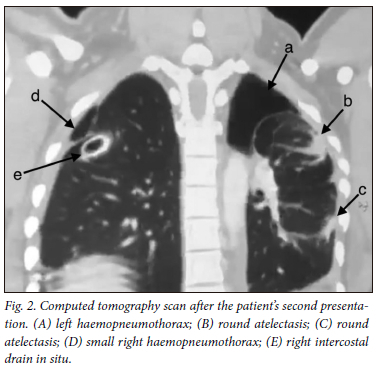 Catamenial pneumothorax: A neglected diagnosis