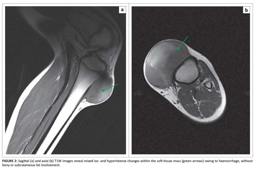 Synovial sarcoma