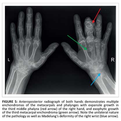 Enchondroma Hand