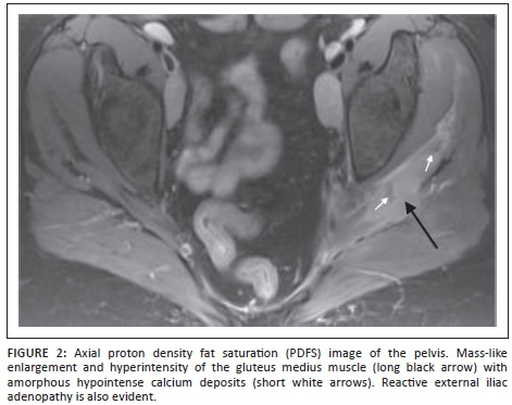 Obturator Internus Mri