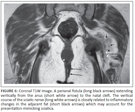 Obturator Internus Mri