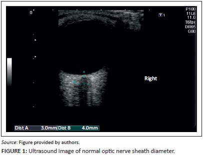 Optic Nerve Sheath Diameter