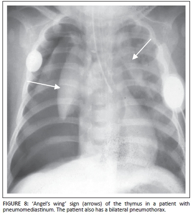 Pitfalls and mimics: The many facets of normal paediatric thymus