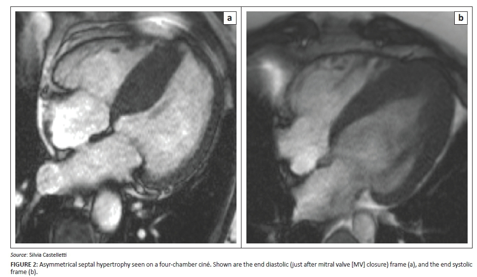 Cardiovascular magnetic resonance in hypertrophic cardiomyopathy and ...