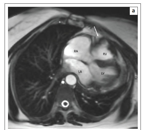 Cardiovascular MRI of the pericardium: A case review of the anatomy ...