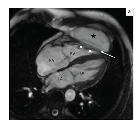 Cardiovascular MRI of the pericardium: A case review of the anatomy ...