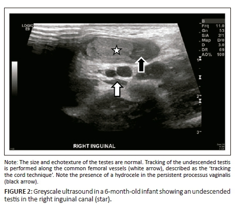 Cryptorchidism Ultrasound