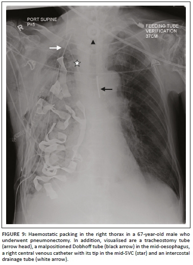 Endotracheal Tube Placement X Ray