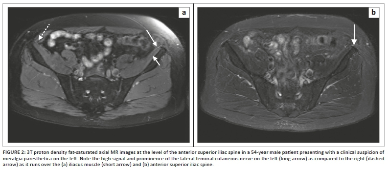 Meralgia paresthetica: Now showing on 3T magnetic resonance neurography