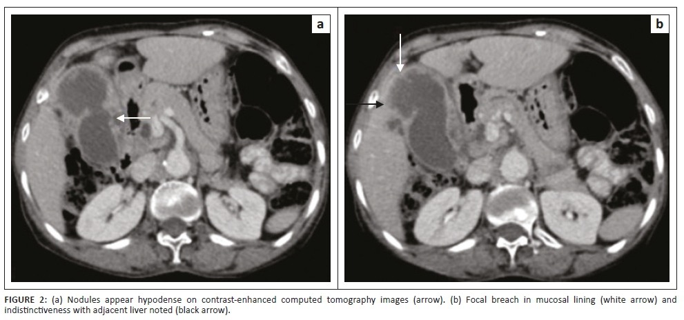 Chronic gallbladder wall thickening: Is it always malignancy?