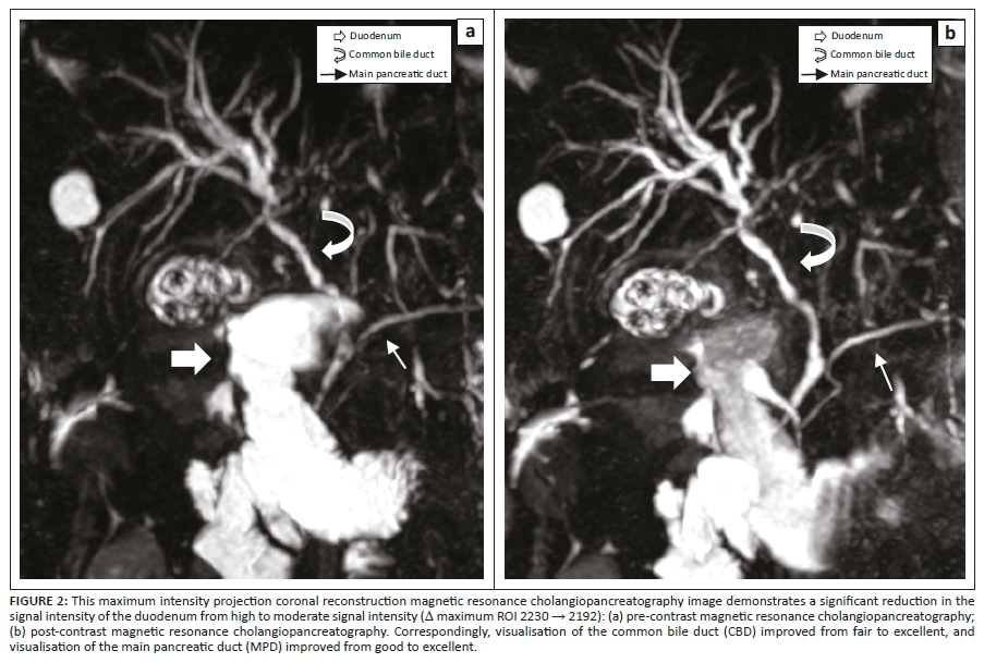 The efficacy of pineapple juice as a negative oral contrast agent in ...