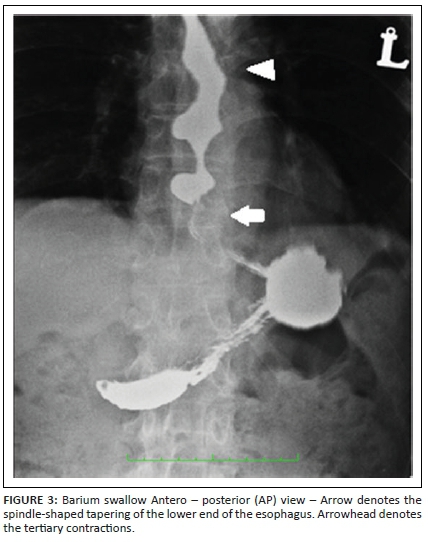 Diffuse Esophageal Spasm Barium Swallow