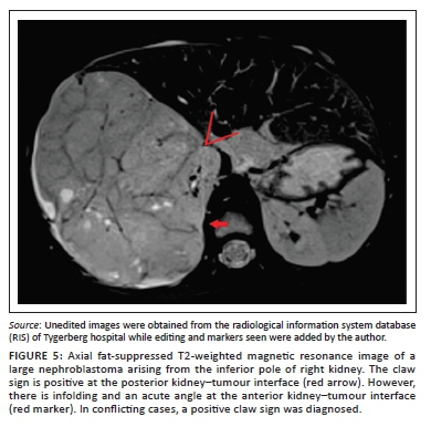 Magnetic resonance imaging for paediatric retroperitoneal masses ...