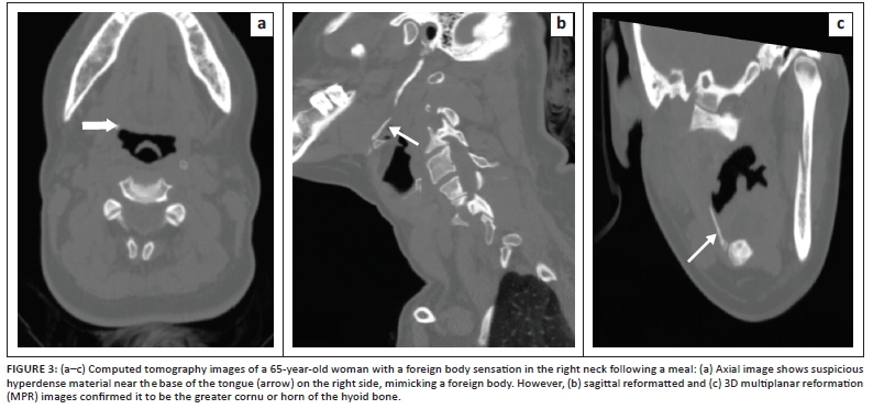 Clinical presentation, diagnosis and management of aerodigestive tract ...