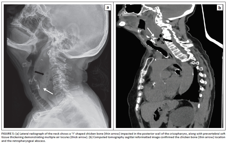 Clinical presentation, diagnosis and management of aerodigestive tract ...