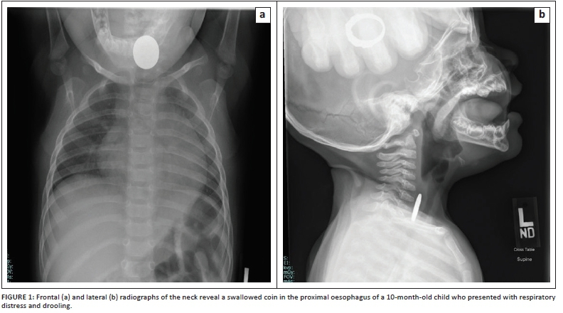 Clinical presentation, diagnosis and management of aerodigestive tract ...