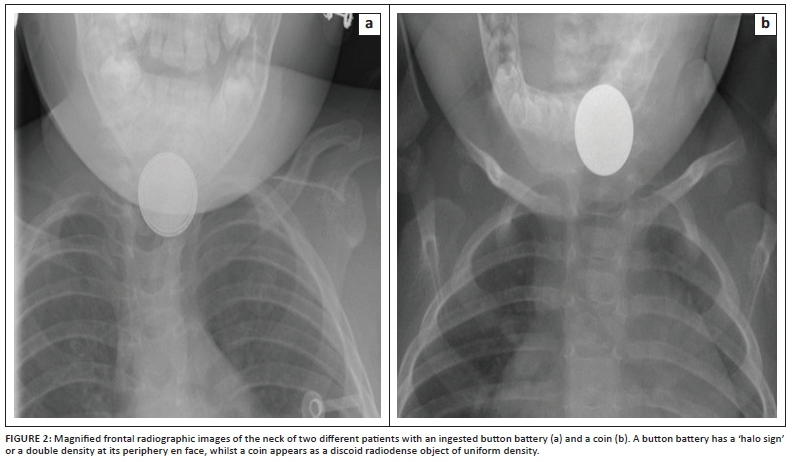 Clinical presentation, diagnosis and management of aerodigestive tract ...