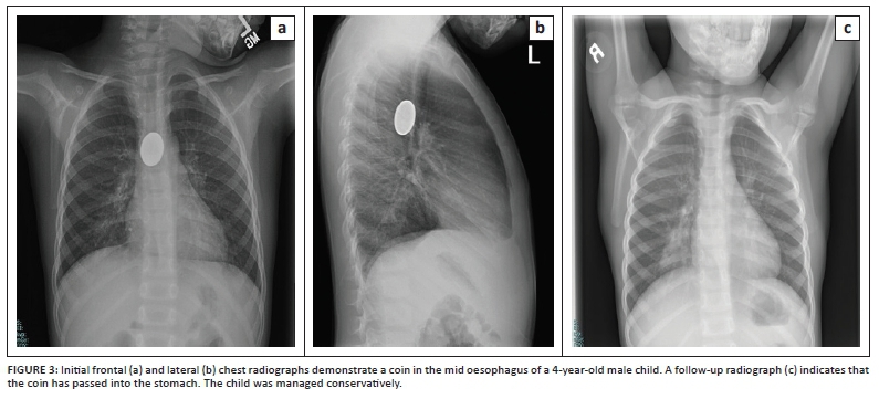 Clinical presentation, diagnosis and management of aerodigestive tract ...
