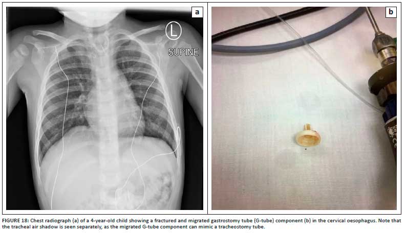 Clinical presentation, diagnosis and management of aerodigestive tract ...