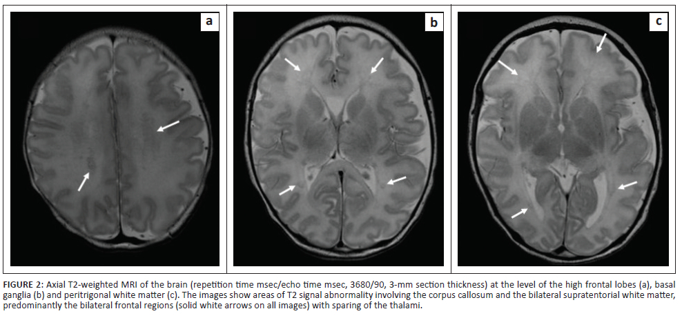 Human parechovirus meningoencephalitis