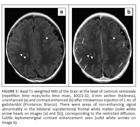 Human parechovirus meningoencephalitis