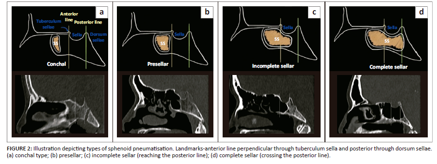 Intrasphenoidal cephalocoeles: Knowing the less known
