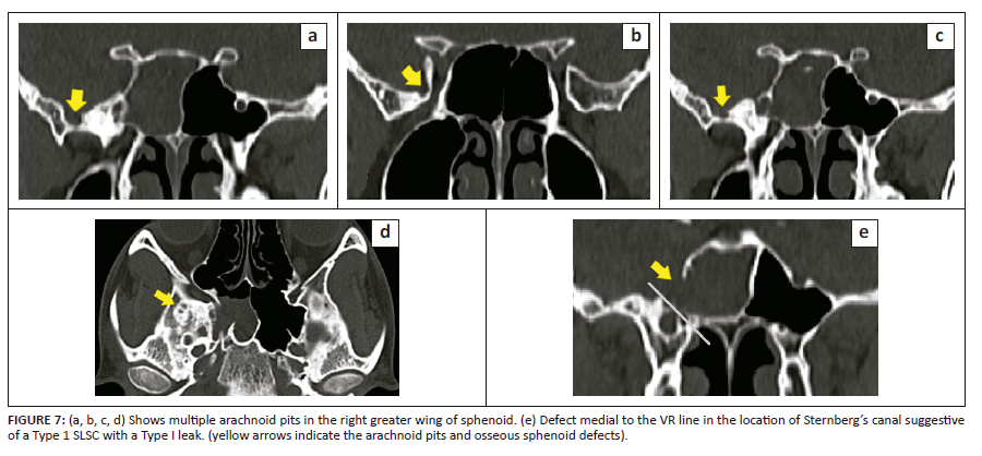 Intrasphenoidal cephalocoeles: Knowing the less known