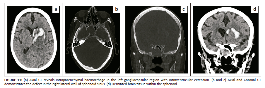 Intrasphenoidal cephalocoeles: Knowing the less known