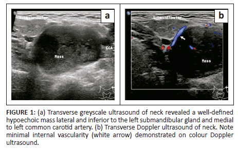 Lyre sign - Where schwannoma mimics a carotid body tumour