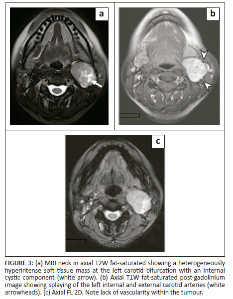 Lyre sign - Where schwannoma mimics a carotid body tumour