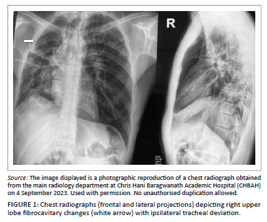 A rare case of intercostal-to-pulmonary artery fistula and its ...
