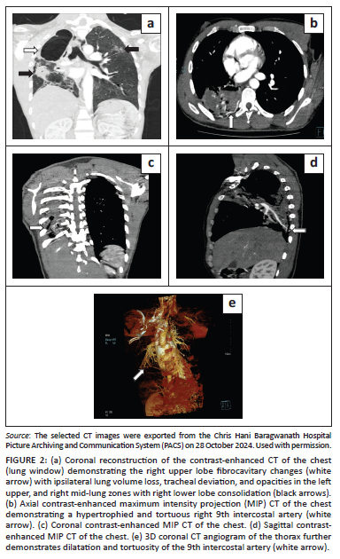A rare case of intercostal-to-pulmonary artery fistula and its ...