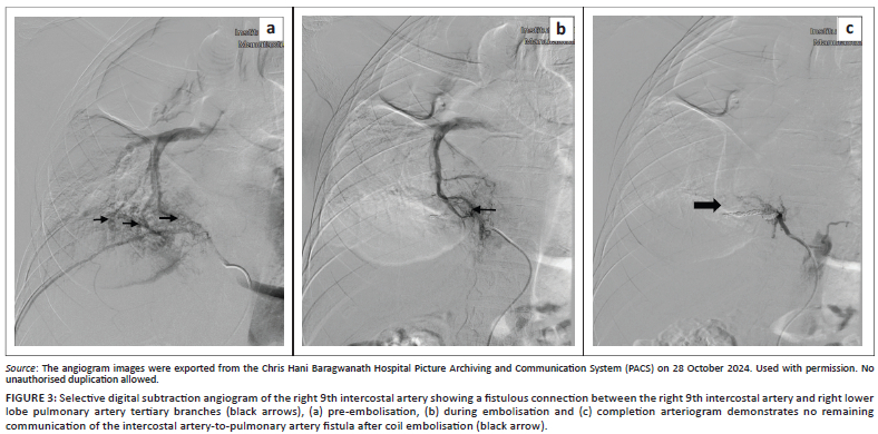 A rare case of intercostal-to-pulmonary artery fistula and its ...