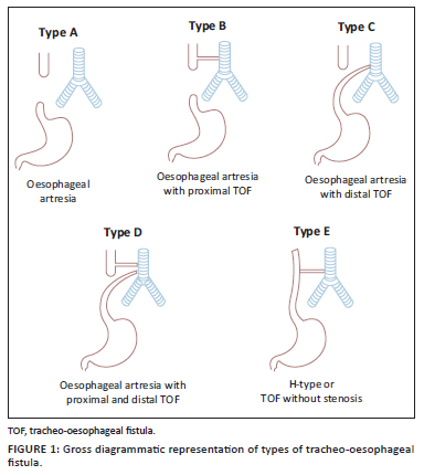 Unveiling tracheo-oesophageal fistula: The crucial role of imaging in ...