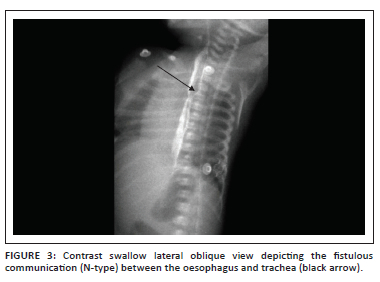 Unveiling tracheo-oesophageal fistula: The crucial role of imaging in ...