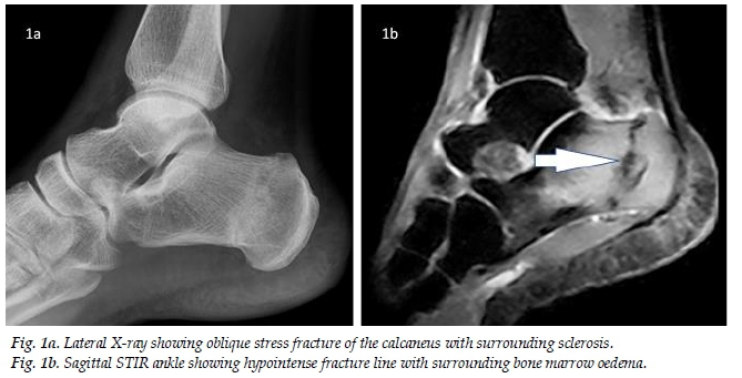 Calcaneus Stress Fracture